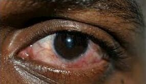 How to treat pink eye | Boksburg Advertiser