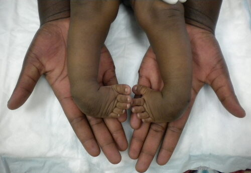 World Clubfoot Day: Step up and change a child’s life - LNN - Network News