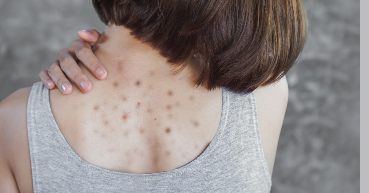 Bacne: Causes, treatments and prevention of back breakouts | Network News