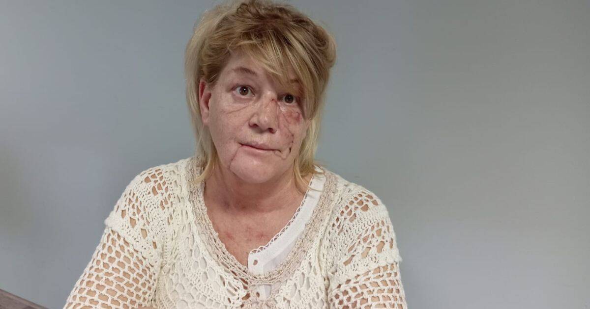 Ouma deur buurvrou se boerboel aangeval | Potchefstroom Herald