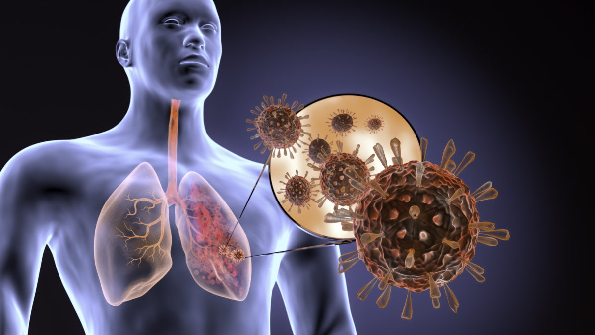 Understanding lung infections and its causes, complications